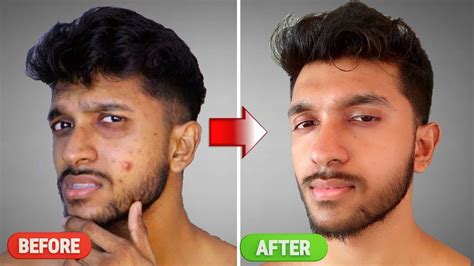 Pimple s වලට වසදම How to keep your face pimple free YouTube
