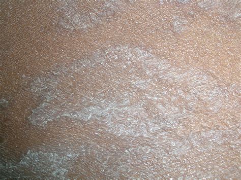 Occasionally Pruritic Rash Mdedge