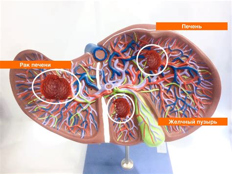 Рак печени причины появления симптомы диагностика и лечение Фосфоглив