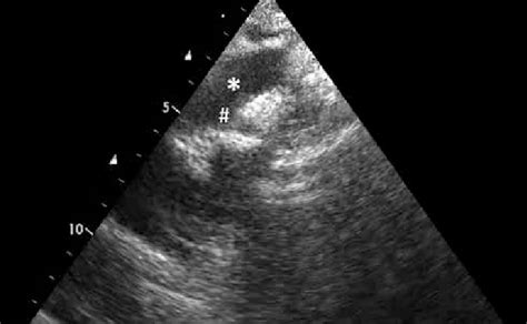 Transthoracic Echocardiographic Tte Image Showing The Suprasternal Download Scientific