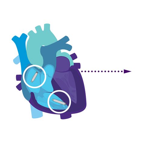 Why Aveir Ar2 Atrial Leadless Pacemaker Abbott