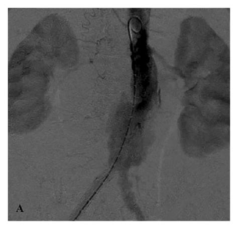 Completion Angiogram After Stent Graft Deployment Showing Type 1a Download Scientific Diagram