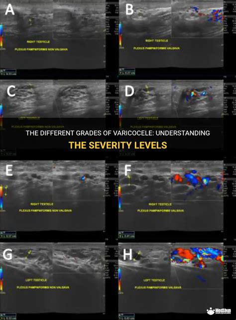 The Different Grades Of Varicocele Understanding The Severity Levels Medshun