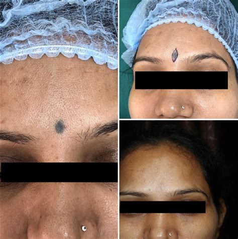 Exploring Surgical Outcomes Of Elliptical Excision Against Relaxed Skin Tension Lines On The