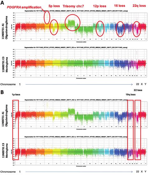 A Array Cgh Profile Demonstrating In The Oligodendroglioma Pdgfra