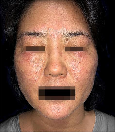 Case For Diagnosis Eyelid Edema And Erythematous Papules Disseminated On The Face Anais
