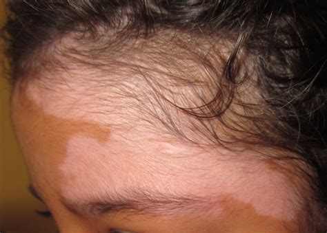 Vitiligo Dermalive