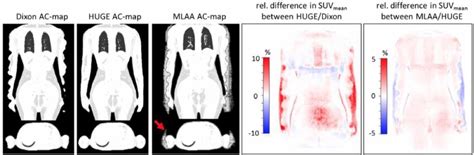 examples of dixon based attenuation map truncation compensation using