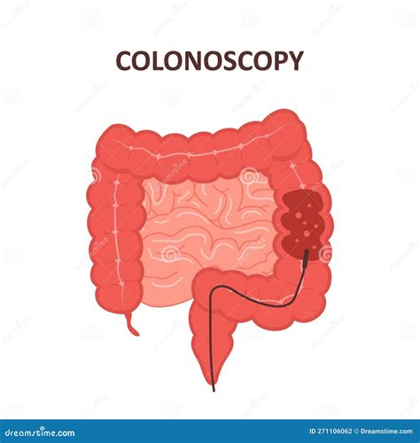Colonoscopy Procedure Intestine Exam And Treatment Colon Polypectomy Concept Prevention Of Colonoscopy Procedure Intestine Exam And Treatment Colon Polypectomy Concept Prevention Of
