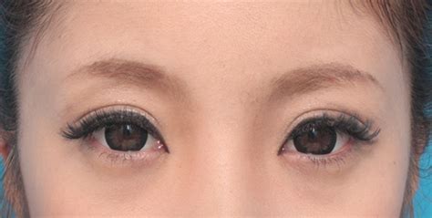 目 大きく する 整形
