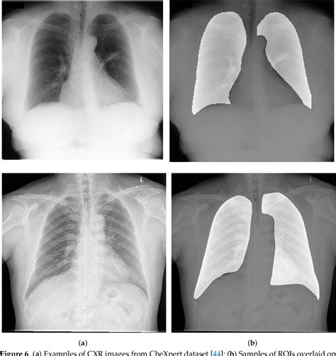 Figure 1 From A Review Of Recent Advances In Deep Learning Models For Chest Disease Detection