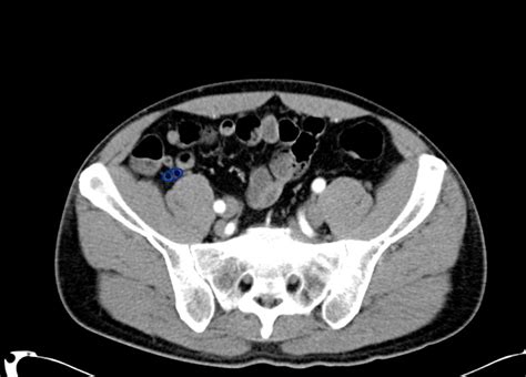A Systematic Approach To The Interpretation Of Ct Abdomen Pelvis