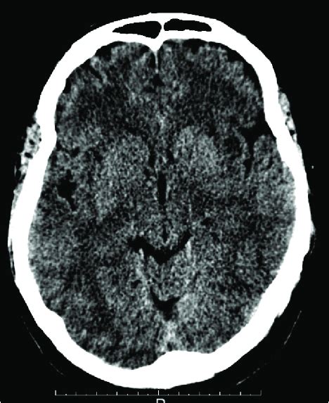Ct Analysis Of Endocranium Before Thrombolysisnormal Findings