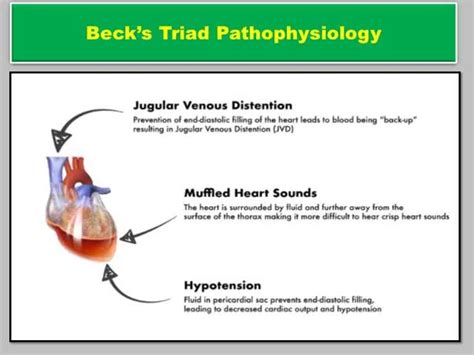 Becks Triad Or Cardiac Tamponade Triad Mnemonic And All Health Kura