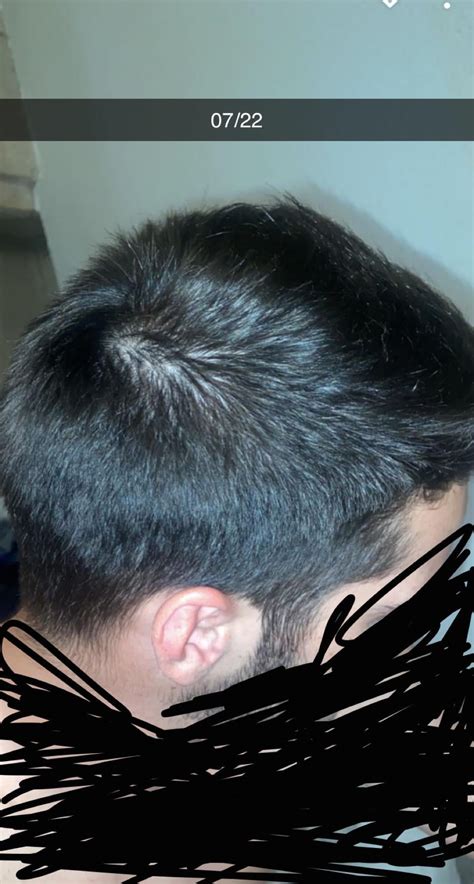 Worsening Of Diffuse Alopecia Despite Treatment Dutas 0 5 5mg Minox 1x D R Tressless