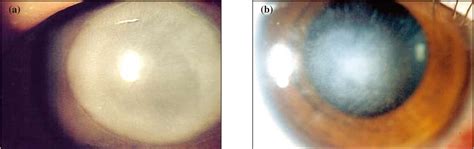 Figure 1 From Review Of Acanthamoeba Keratitis Associated With Contact
