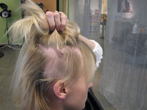 This Funky Junky Injections In My Scalp