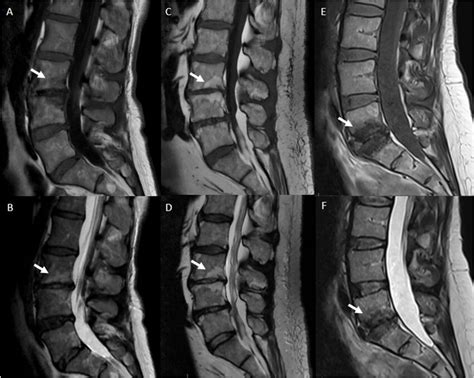 Modic Alterations Sagittal T1 Weighted And T2 Weighted Mr Images Download Scientific Diagram