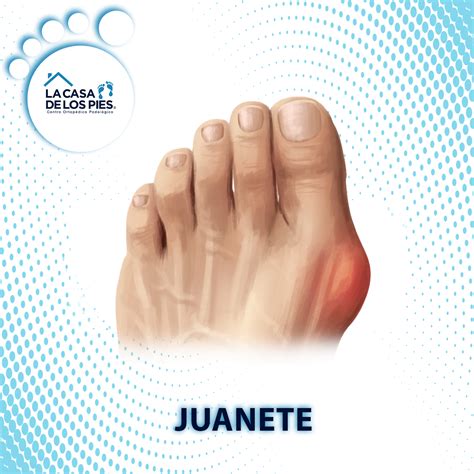 La Casa De Los Pies Con Un Juanete La Base Del Dedo Gordo Del Pie Articulación