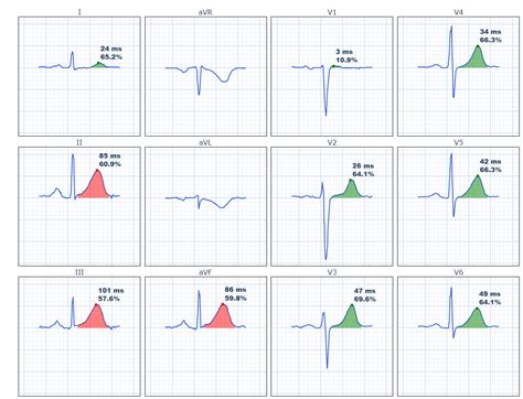 Dr Smith S Ecg Blog What Makes A T Wave Hyperacute And 30 Examples