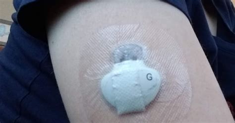 Medtronic Cgm Sensor Insertion Sensor Education Blog