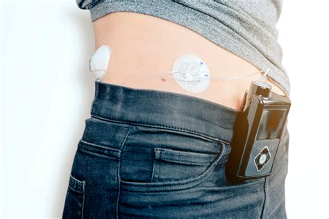 Best Practices Around Using An Insulin Pump And Sensor Edgepark HealthInsights