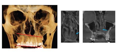 Innovation Improvement Of Nasal Septal Deviation In Response To