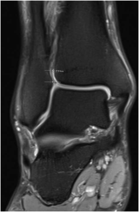 Imaging Of Acute Ankle And Foot Sprains Radiologic Clinics