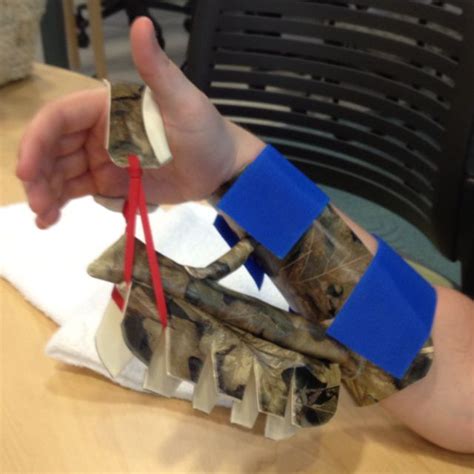 Dinosaur Splint Dynamic Wrist Flexion I Have Never Made On Eof These