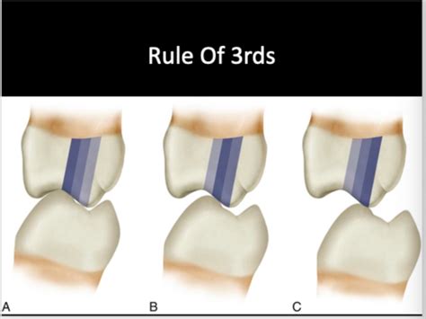 110 Occlusion Ii Treatment Sequencing Flashcards Quizlet