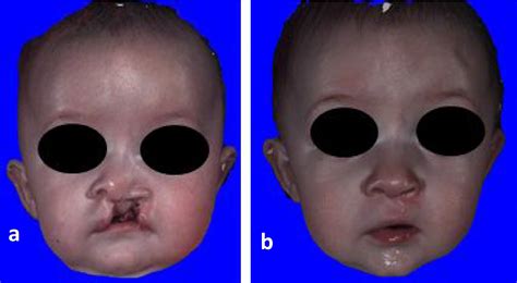 Assessment Of Facial Asymmetry Before And After The Surgical Repair Of