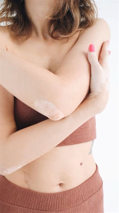 A Woman Having Skin Discoloration On Her Hands Free Stock Video Footage