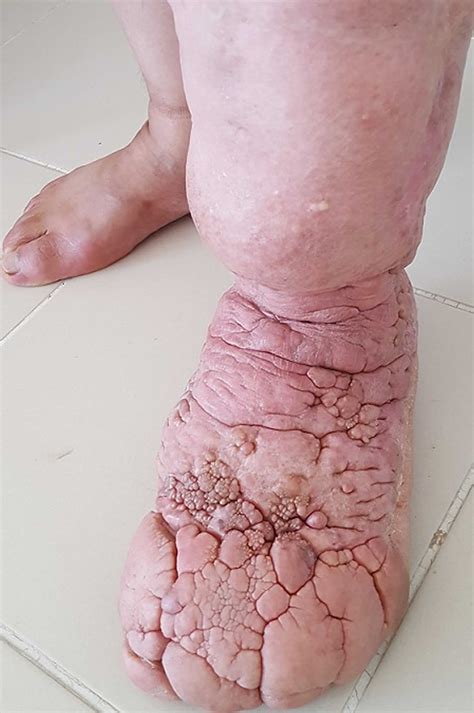 Elephantiasis Worm Life Cycle