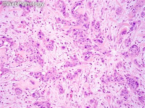 Gallbladder Carcinoma Histologic Grading