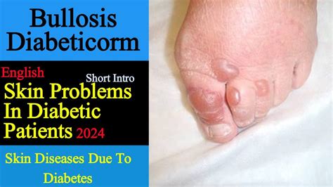 Diabetic Dermopathy I Diabetes Skin Diseases I Bullosis Diabetocorm I
