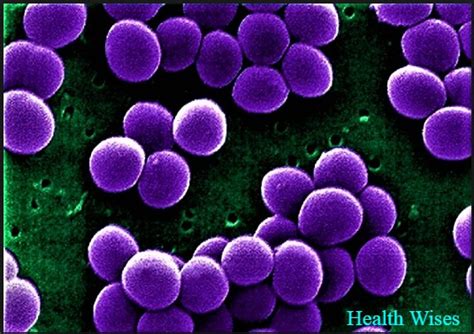 Things To Avoid When Treating Staph Aureus Infection Health Nigeria