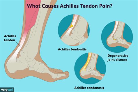 Achilles Tendinitis Achilles Tendonitis Achilles Tendon Pain Physio