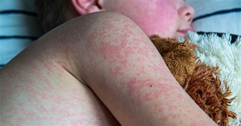 Measles Pertussis Mpox Are Vaccine Preventable Johns Hopkins