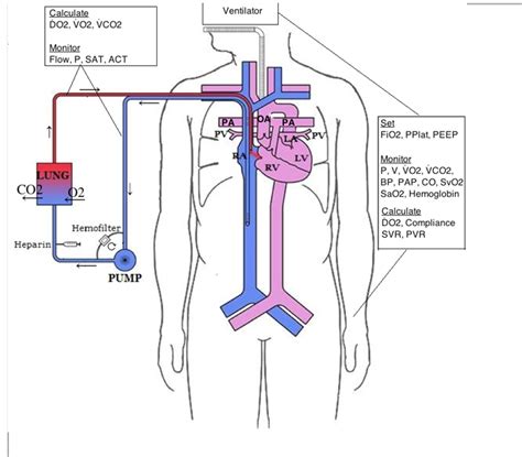 Ecmo With Lv Vent