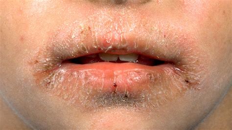 Mouth Eczema Seborrheic Dermatitis Causes And Treatment La Roche