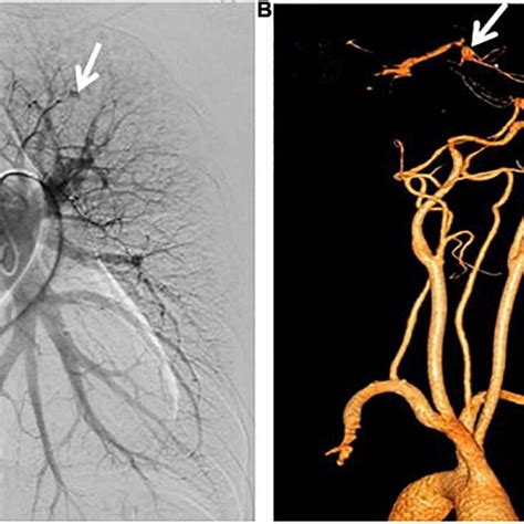 Pulmonary Angiography And Cranial Computed Tomographic Angiogram A