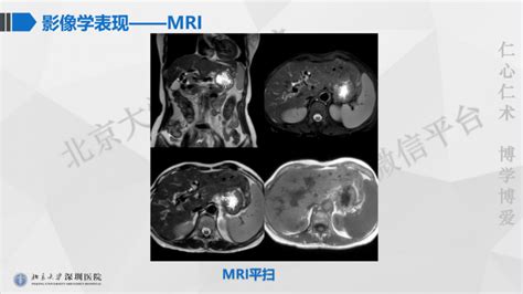 【ppt】遗传性出血性毛细血管扩张症 影像ppt