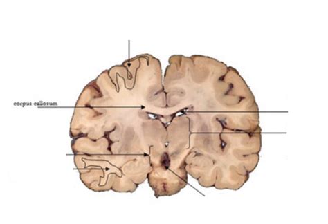 Coronal View Brain Diagram Quizlet