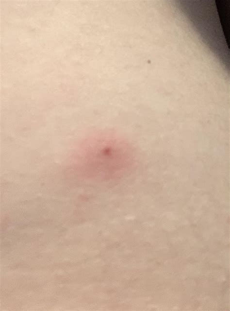 Deer Tick Bite Mark