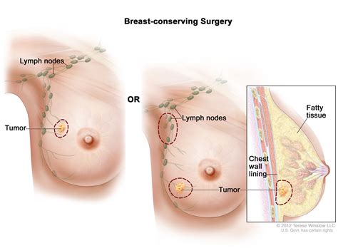 Lumpectomy Procedure Preserving Health And Aesthetics Aesthetic And