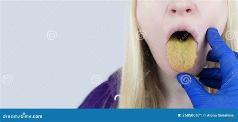 The Man Has A Yellow Tongue Painful Yellow Coating On The Mucous