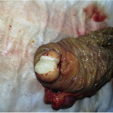 Normal Appearance Of The Appendix On Ct The Normal Appendix Arrow