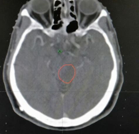 Computed Tomography Axial Section Showing Tumor In The Midbrain Before