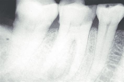 D Case Iipreoperative Radiograph Download Scientific Diagram