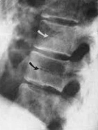 Thoracolumbar Anomalies And Normal Variants Flashcards Quizlet